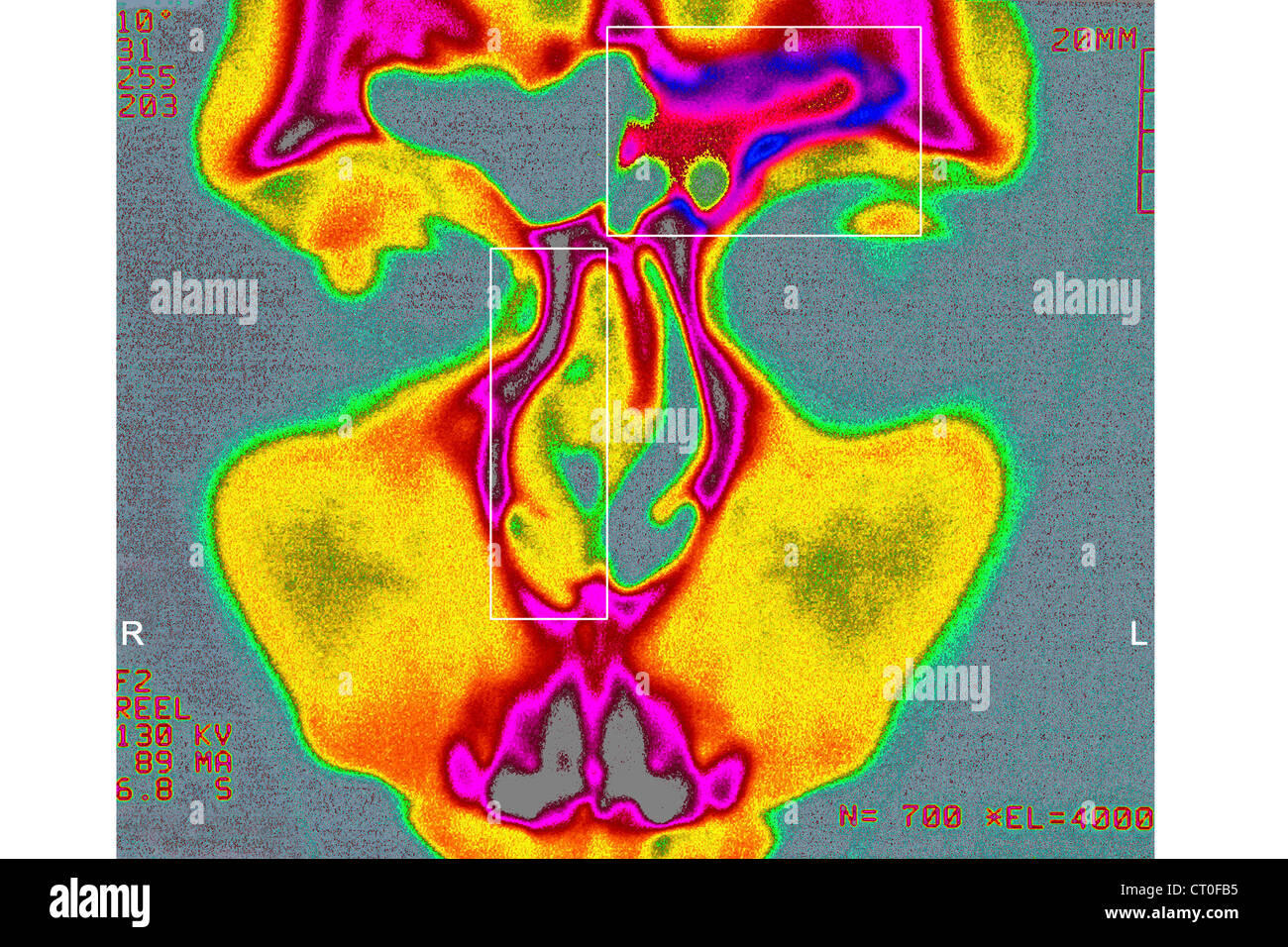 Sinus mri hi-res stock photography and images - Alamy