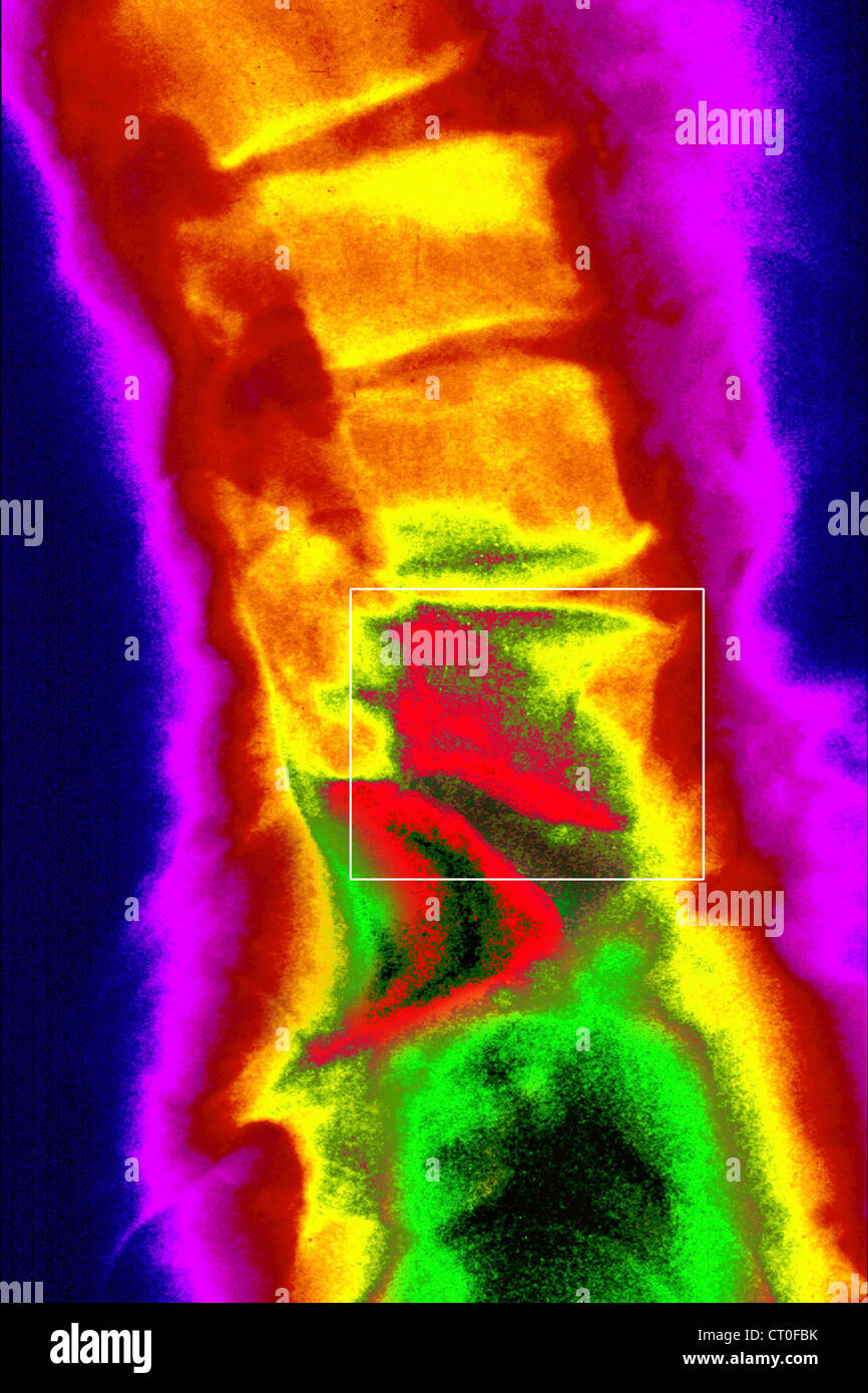 COMPRESSION FRACTURE, MRI Stock Photo - Alamy