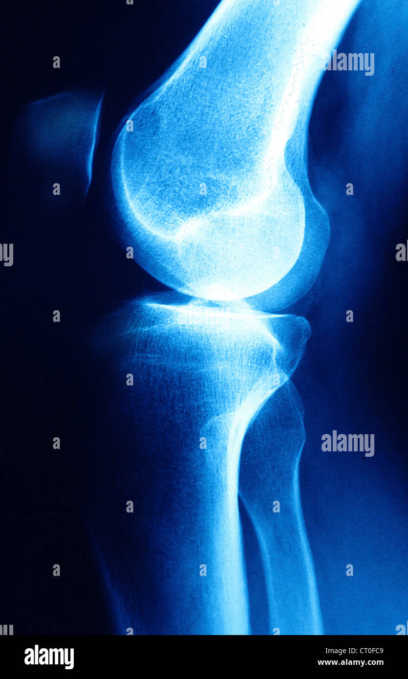 Normal knee x ray hi-res stock photography and images - Alamy