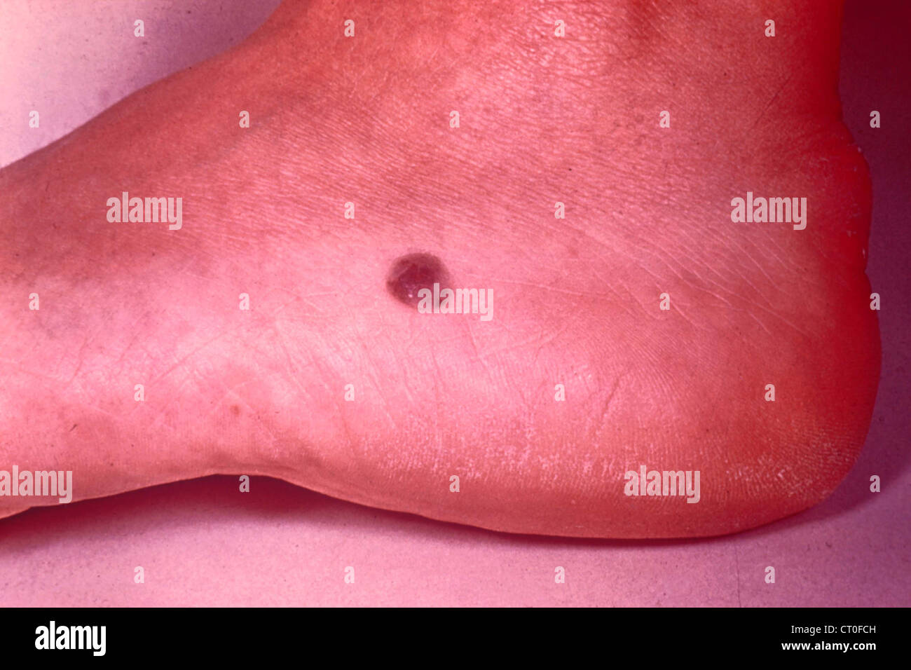 Malignant melanomas hi-res stock photography and images - Alamy