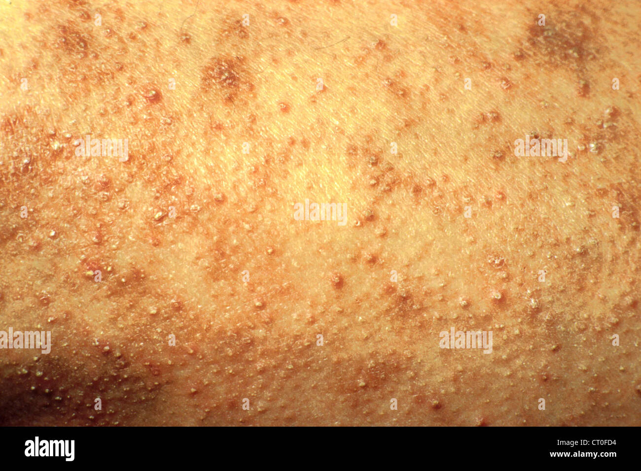 Pityriasis hi-res stock photography and images - Alamy