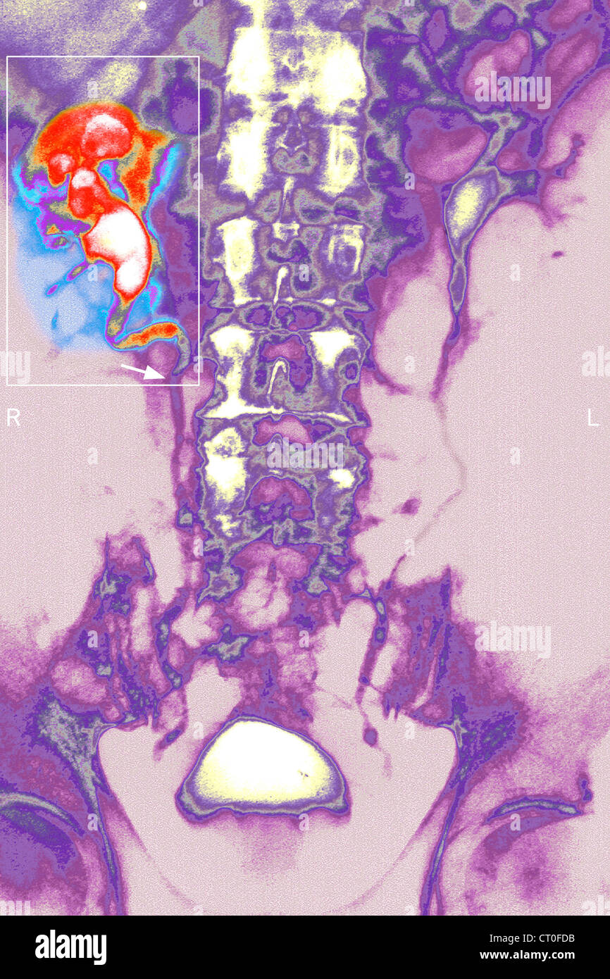 URETERAL LITHIASIS, X-RAY Stock Photo - Alamy