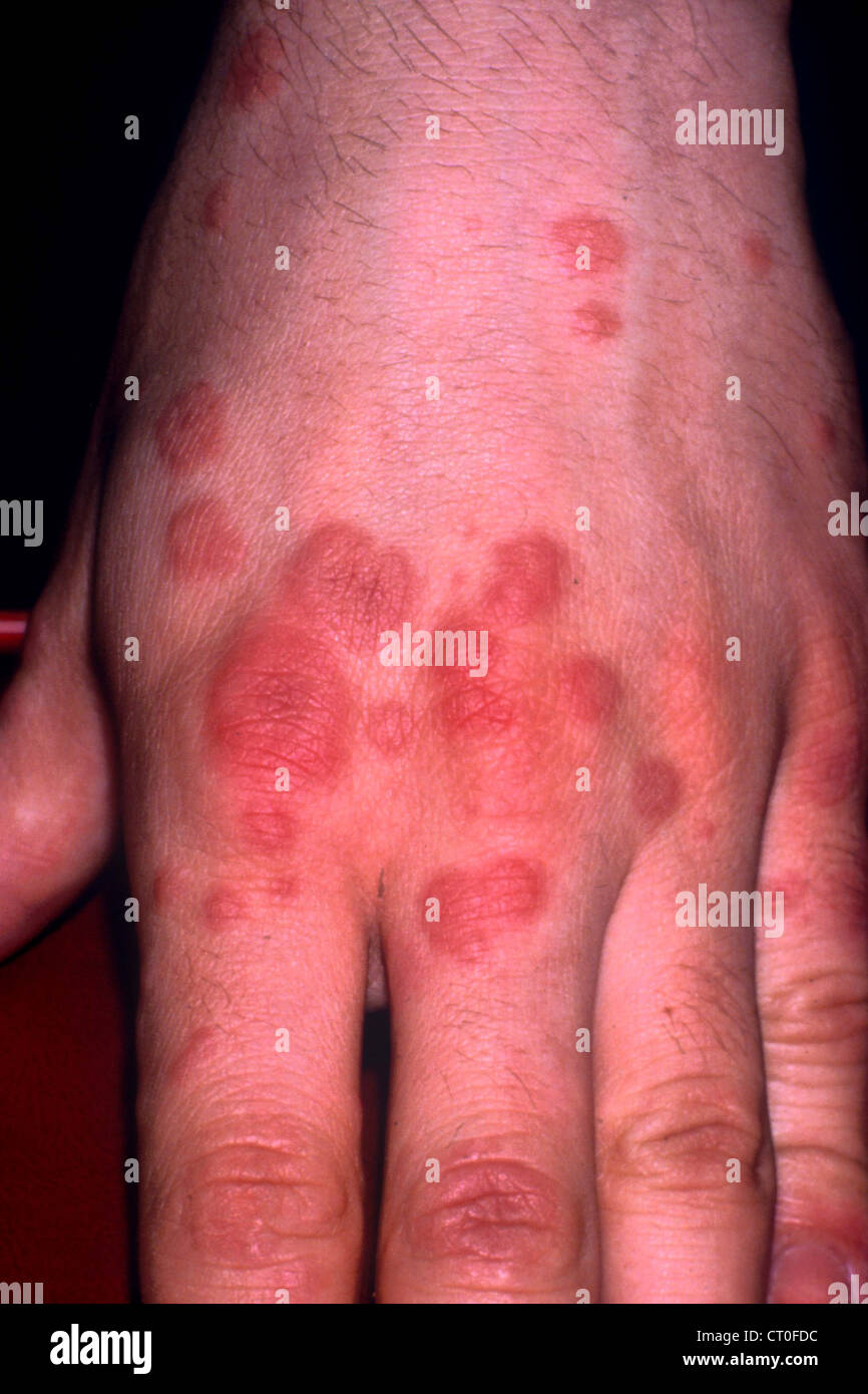 Erythema multiform hi-res stock photography and images - Alamy