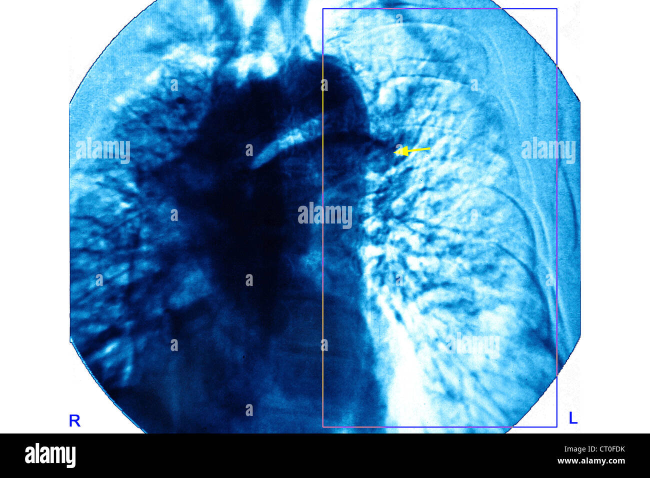 PULMONARY EMBOLISM, ANGIOGRAPHY Stock Photo - Alamy