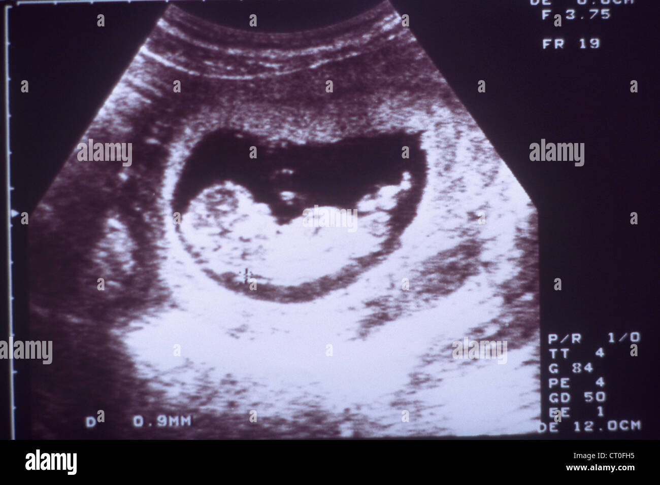 ULTRASOUND BIOMETRY OF THE FETUS Stock Photo - Alamy