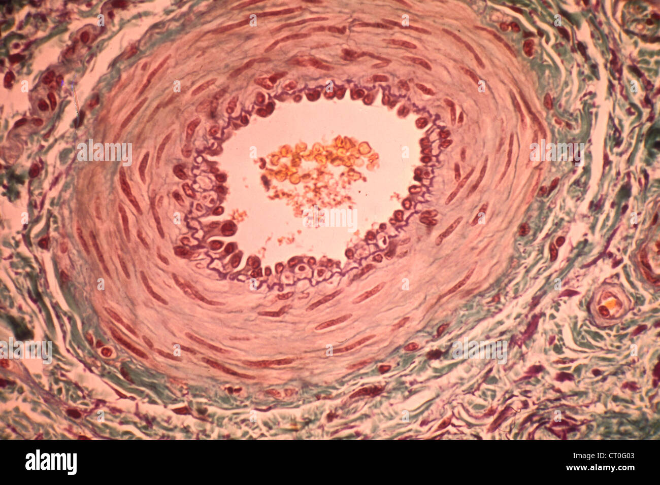 Atheromas hi-res stock photography and images - Alamy