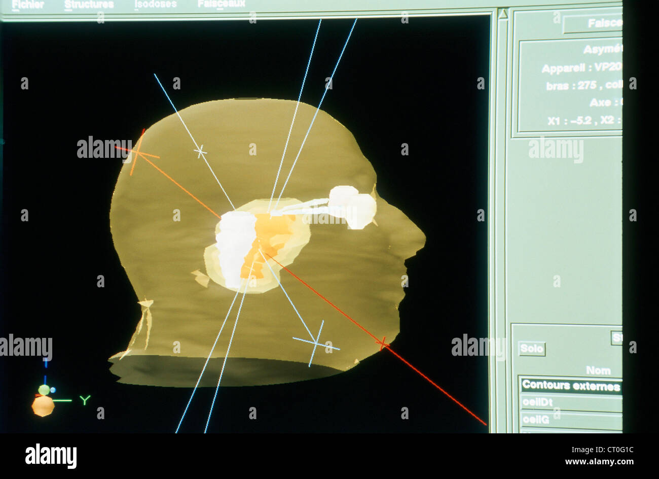 BRAIN CANCER RADIOTHERAPY Stock Photo - Alamy