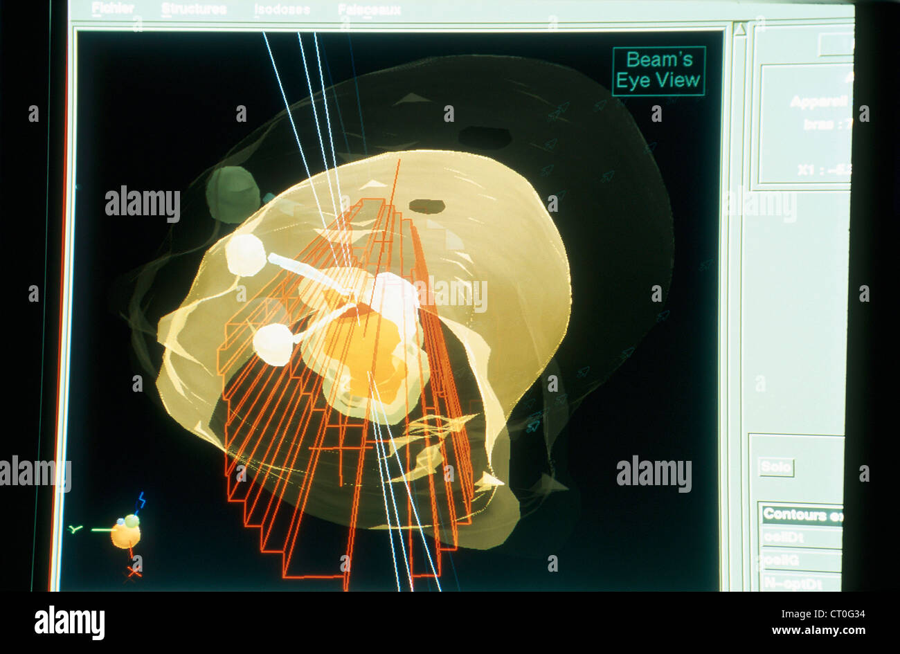 BRAIN CANCER RADIOTHERAPY Stock Photo - Alamy
