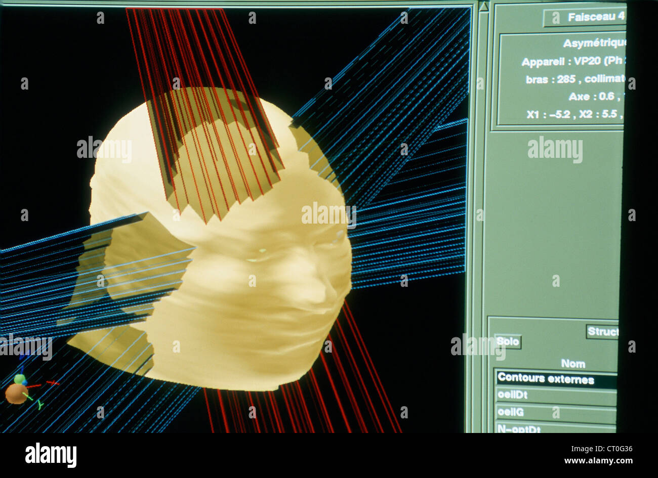 BRAIN CANCER RADIOTHERAPY Stock Photo - Alamy