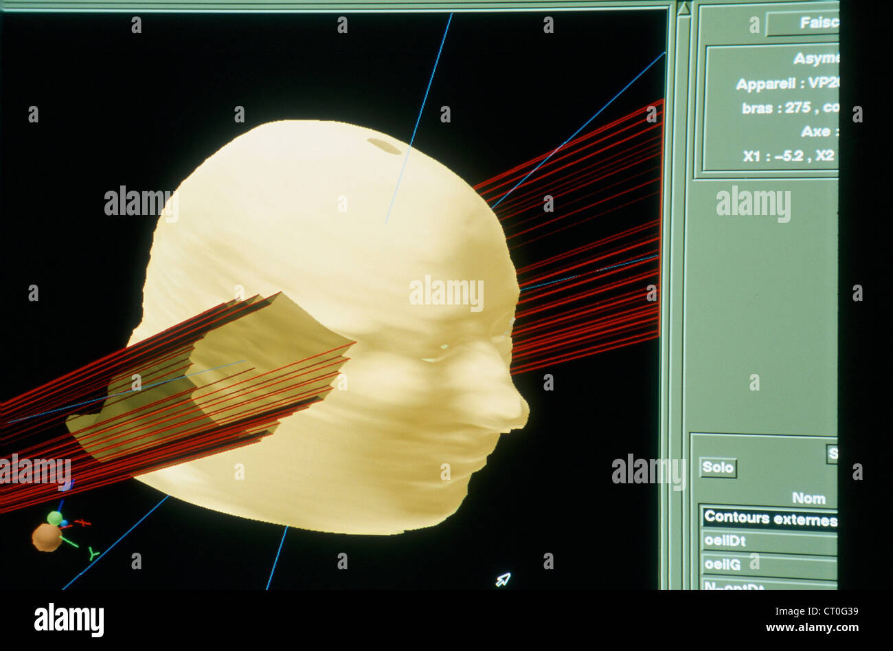 BRAIN CANCER RADIOTHERAPY Stock Photo - Alamy