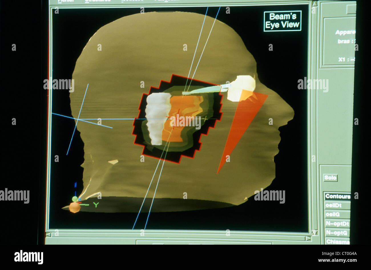 BRAIN CANCER RADIOTHERAPY Stock Photo - Alamy