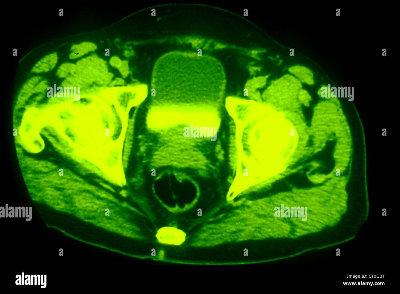 PROSTATE CANCER, SCAN Stock Photo - Alamy