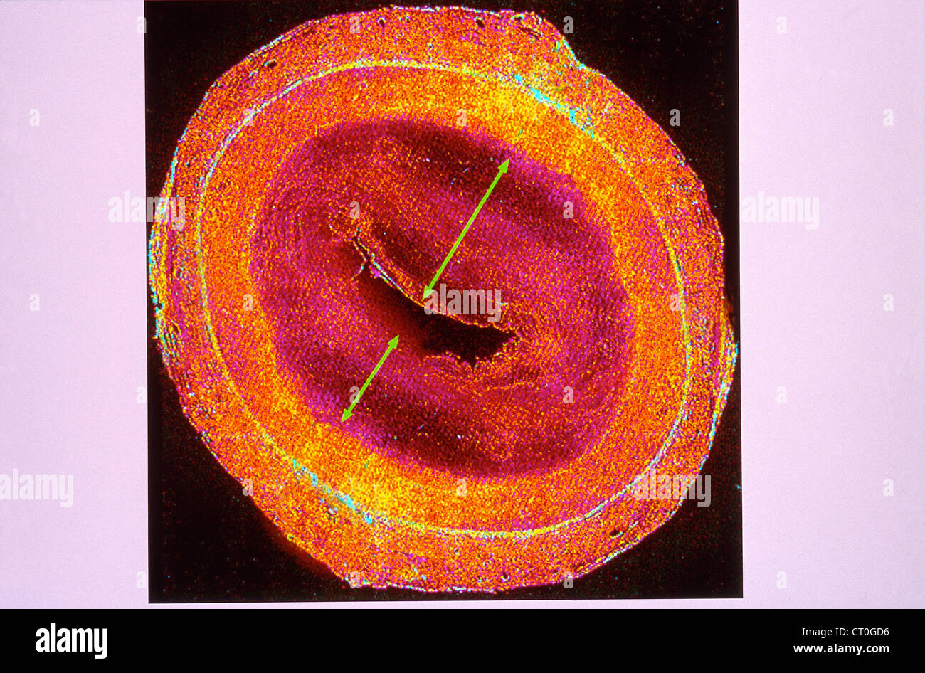 Atheromatic hi-res stock photography and images - Alamy