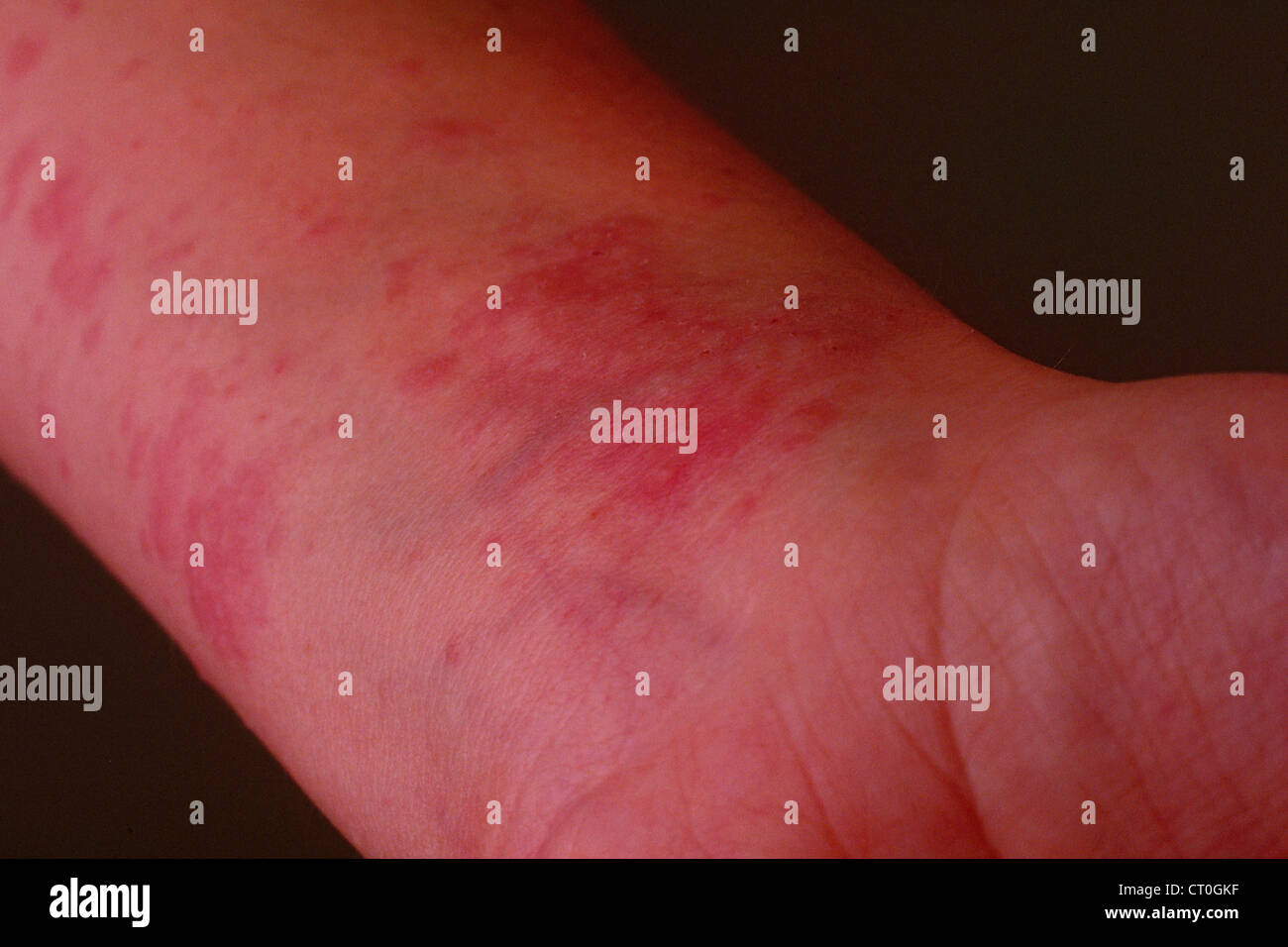 Urticarias hi-res stock photography and images - Alamy