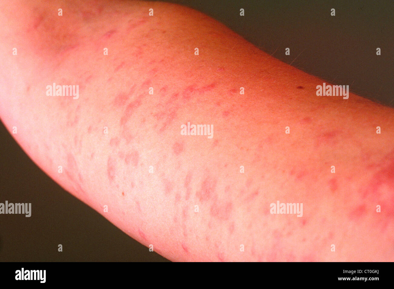 Urticarias hi-res stock photography and images - Alamy