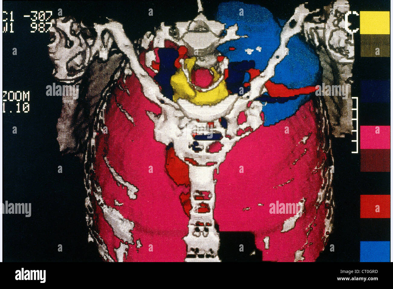 Endothoracic hi-res stock photography and images - Alamy