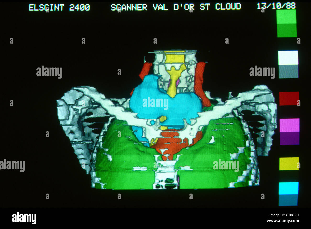 THYROID NODULE, SCAN Stock Photo - Alamy THYROID NODULE, SCAN Stock Photo - Alamy
