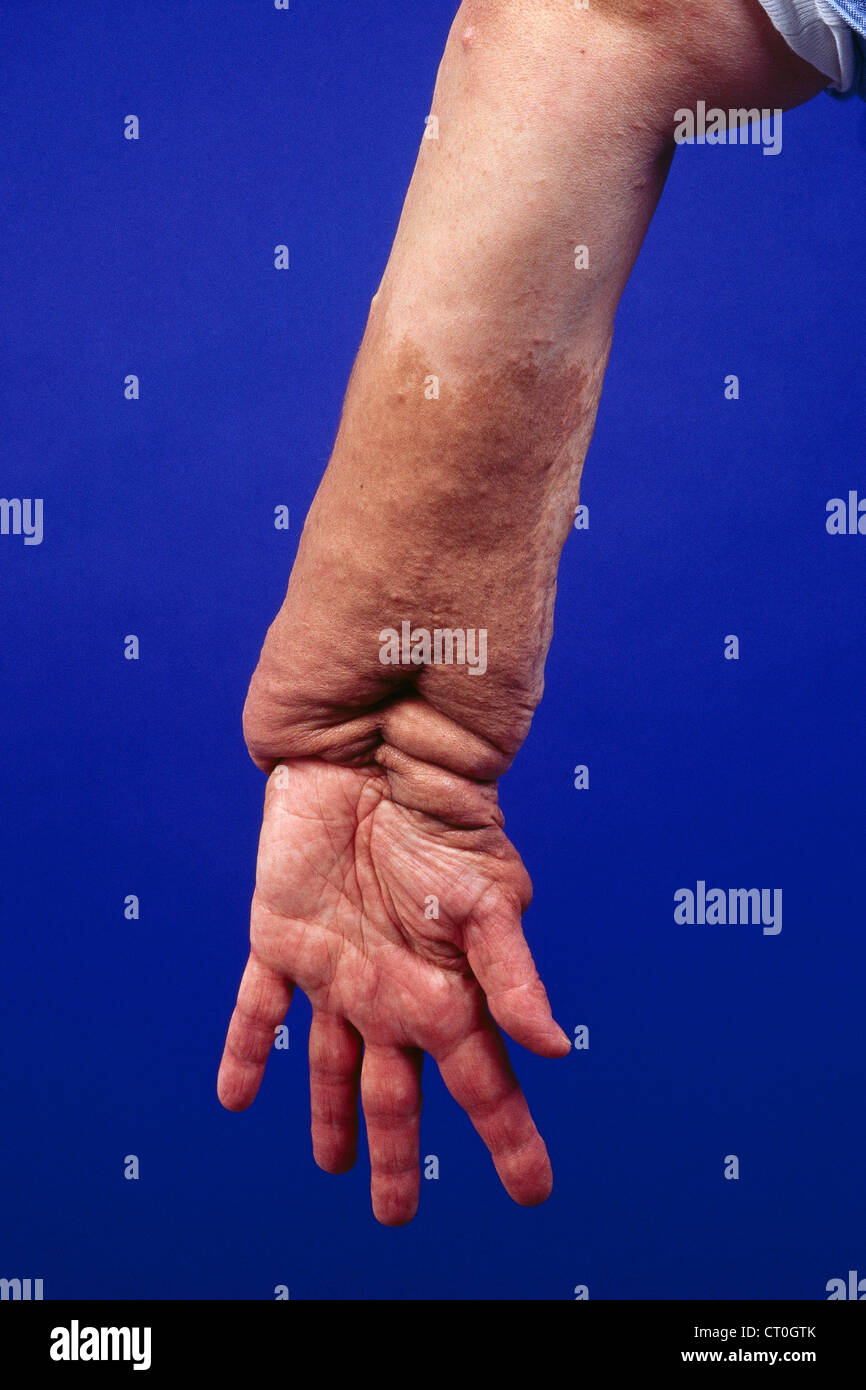 Von recklinghausens disease hi-res stock photography and images - Alamy