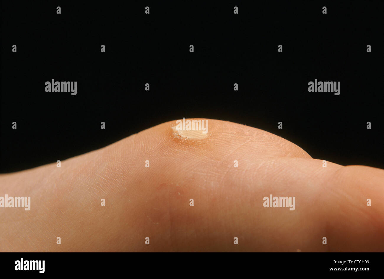 Phlyctena hi-res stock photography and images - Alamy