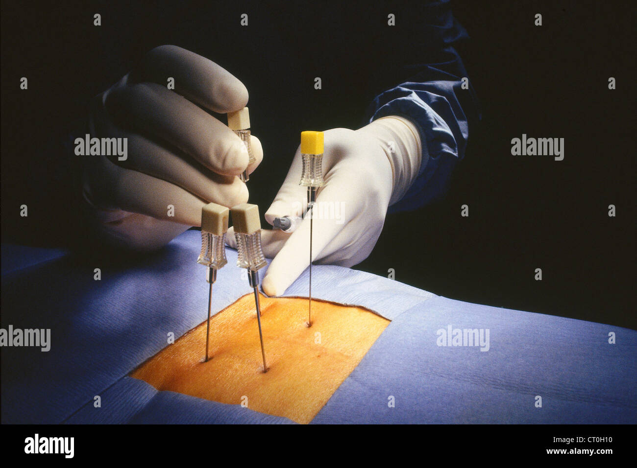 Percutaneous nucleotomy hi-res stock photography and images - Alamy