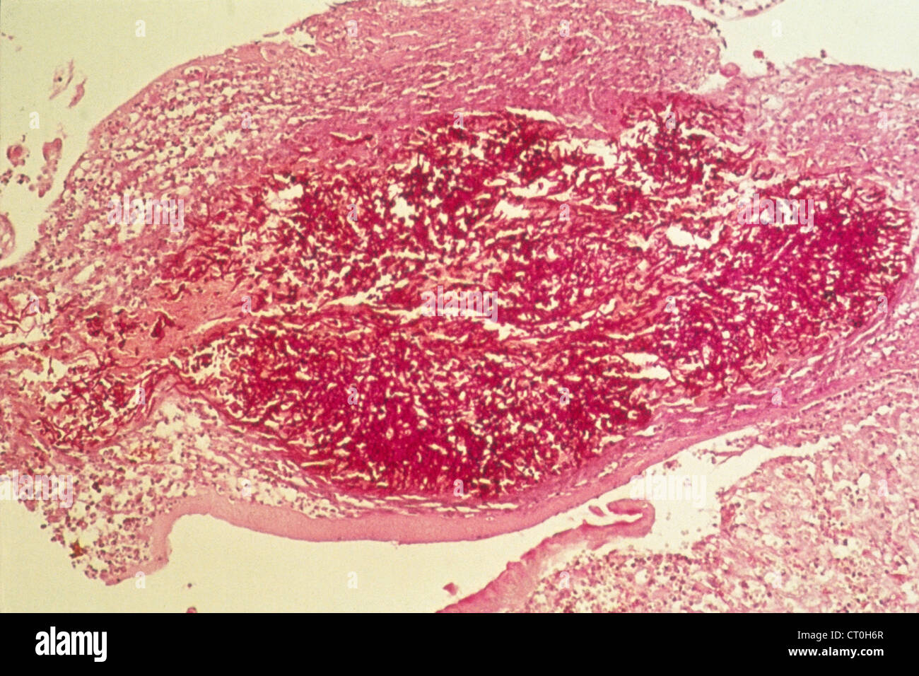 Candidiasis test hi-res stock photography and images - Alamy