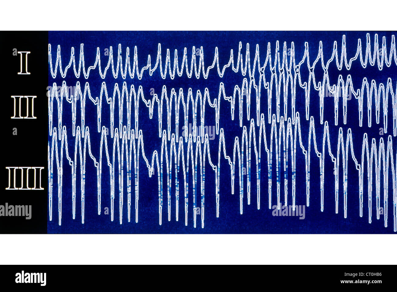 AURICULAR FIBRILLATION, ECG Stock Photo - Alamy