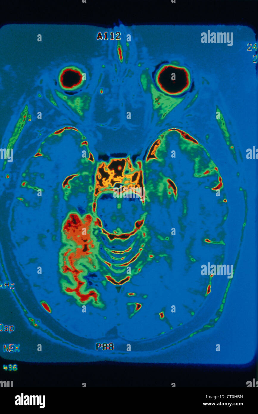 BRAIN HEMORRHAGE, MRI Stock Photo - Alamy
