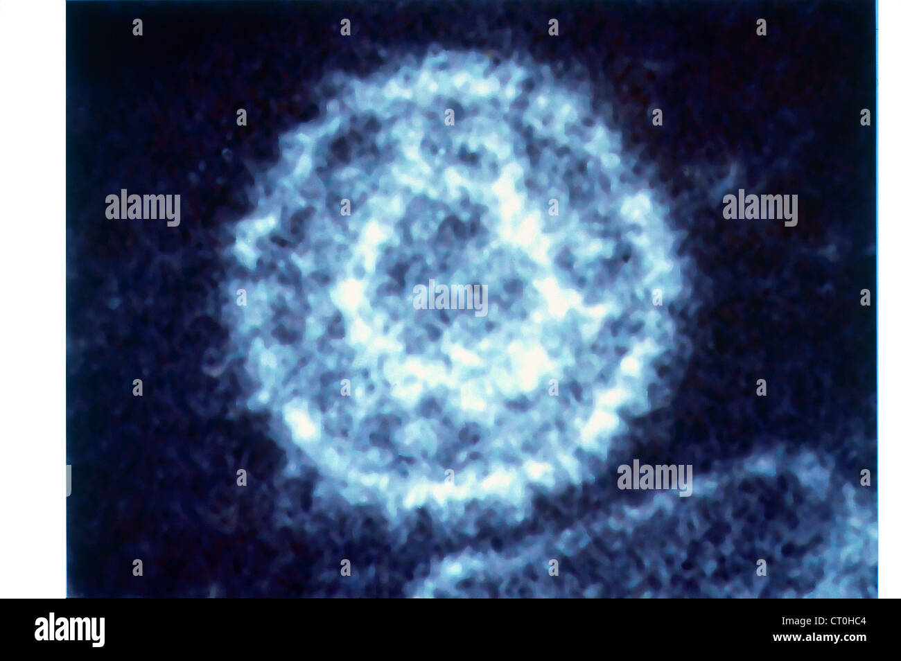 Glandular fever hi-res stock photography and images - Alamy