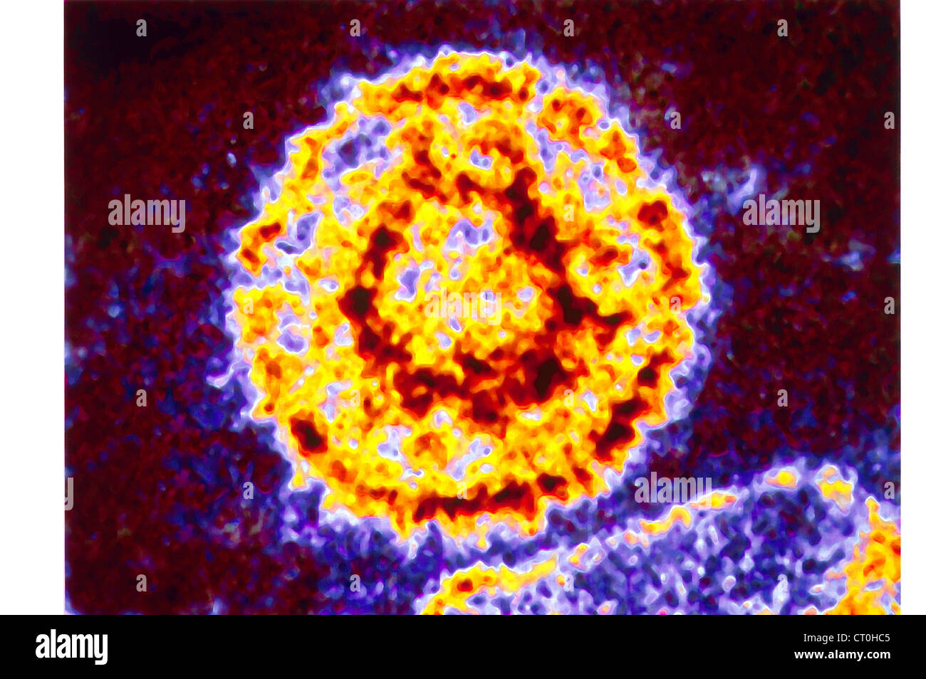 Glandular fever hi-res stock photography and images - Alamy
