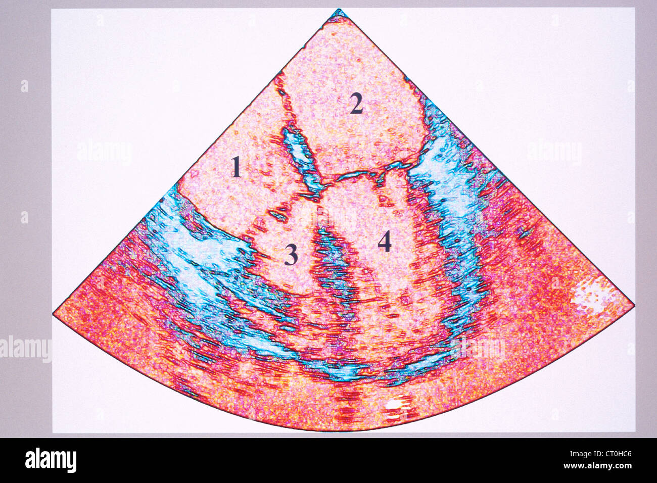 HEART, SONOGRAPHY RESULT Stock Photo - Alamy