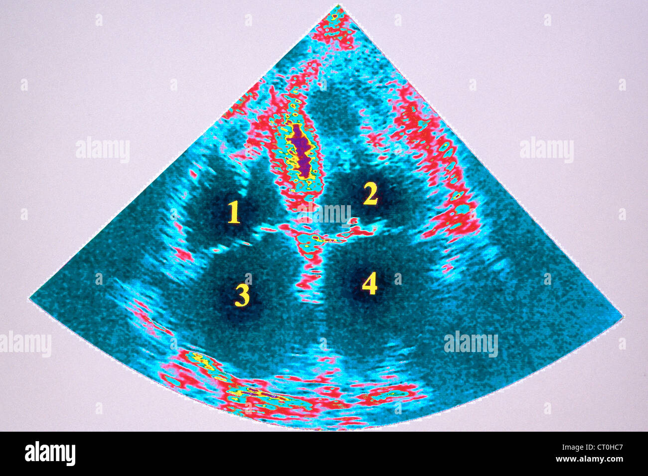HEART, SONOGRAPHY RESULT Stock Photo - Alamy