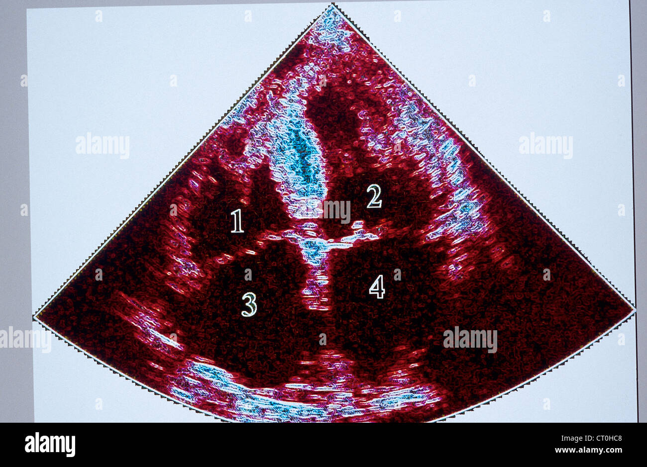 HEART, SONOGRAPHY RESULT Stock Photo - Alamy