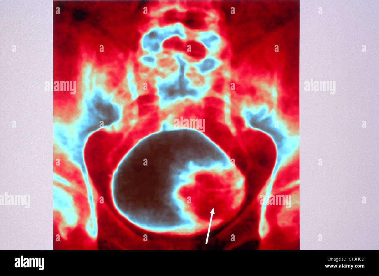 Tumor Of The Bladder Stock Photos & Tumor Of The Bladder Stock Images ...