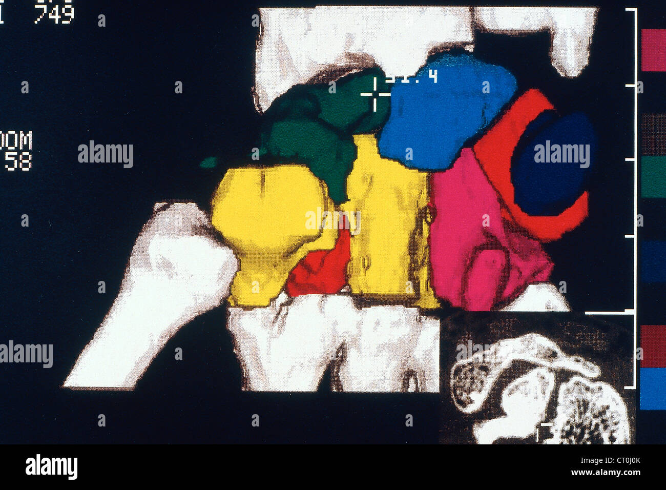 FRACTURED WRIST, SCAN Stock Photo - Alamy