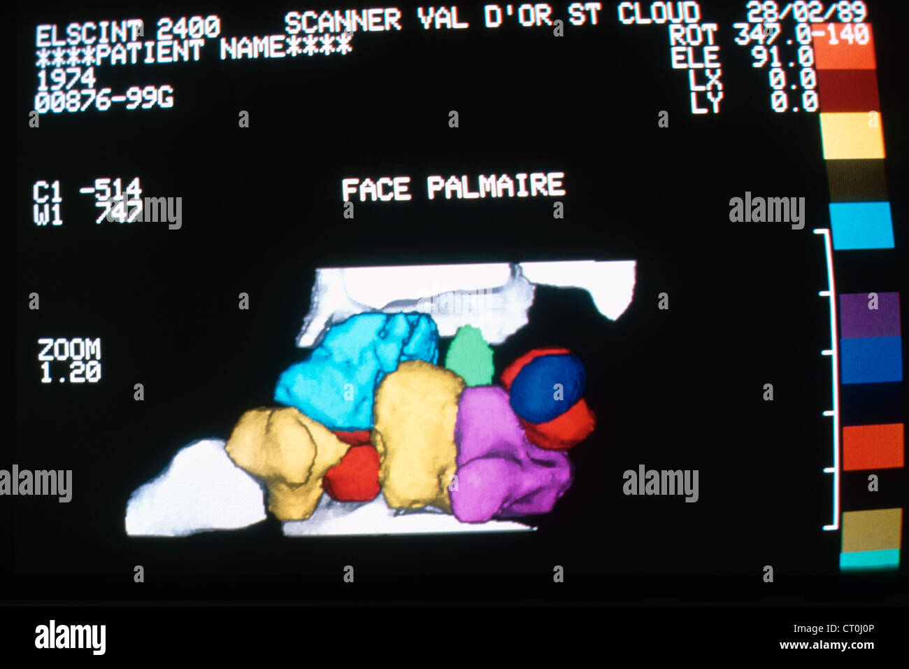 FRACTURED WRIST, SCAN Stock Photo - Alamy