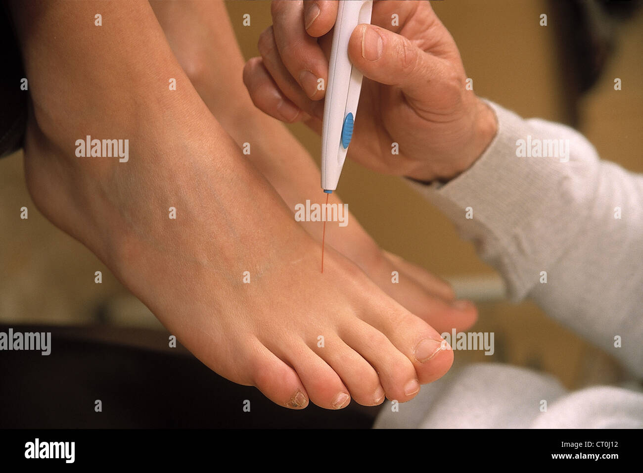Peripheral neuropathy test hi-res stock photography and images - Alamy