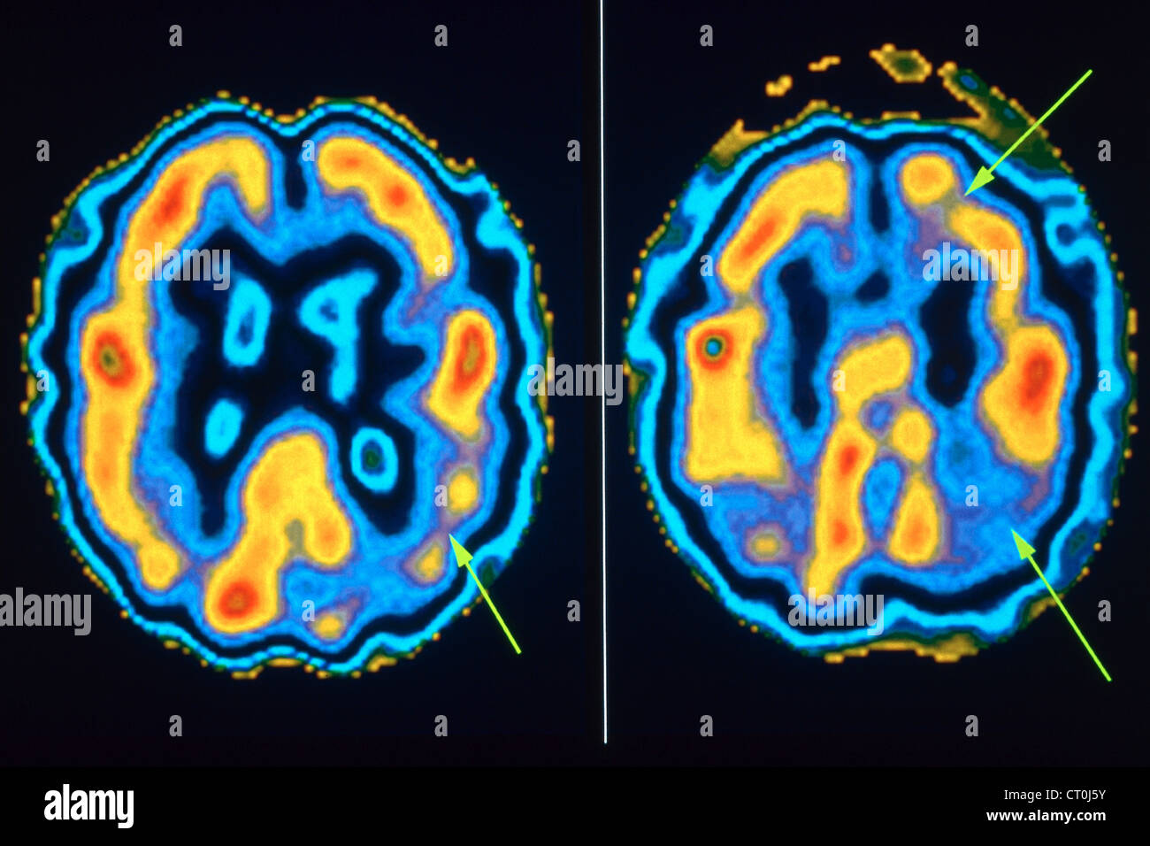 Gamma scan brain hi-res stock photography and images - Alamy