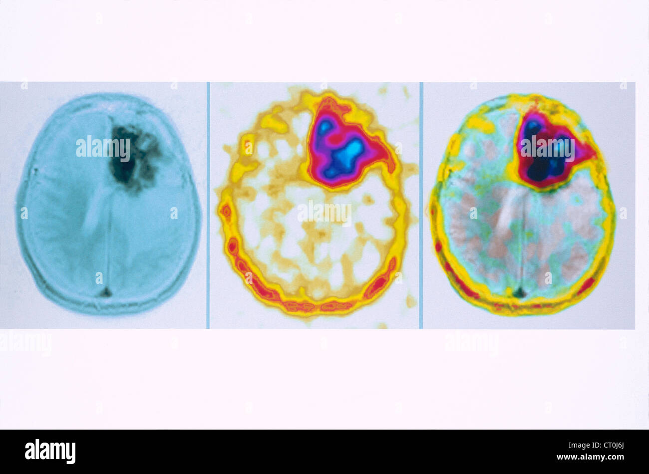 MALIGNANT TUMOR, BRAIN SCAN Stock Photo - Alamy