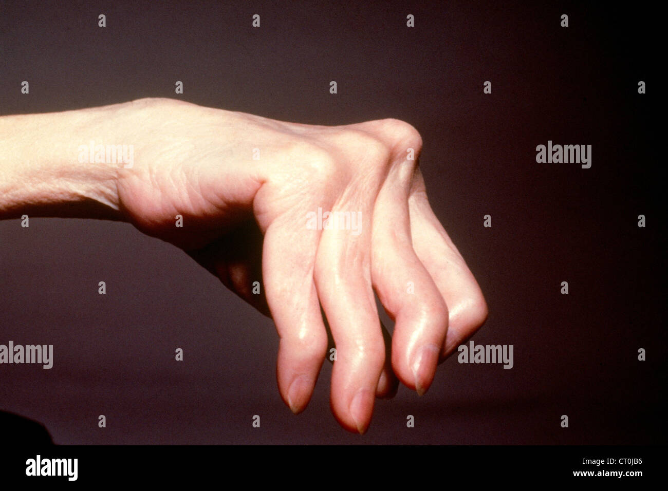 Hand deformities hi-res stock photography and images - Alamy