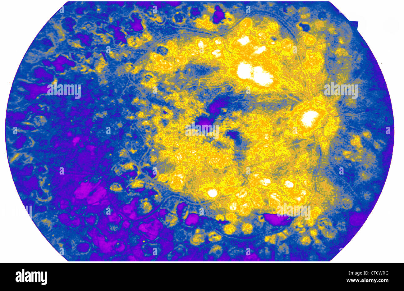 DIABETIC RETINOPATHY Stock Photo - Alamy DIABETIC RETINOPATHY Stock Photo - Alamy