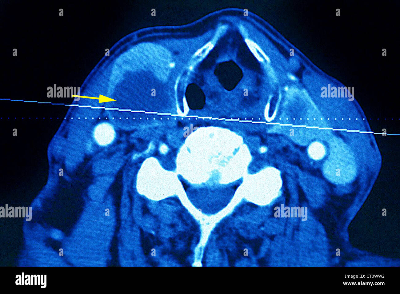 THYROID NODULE, SCAN Stock Photo - Alamy