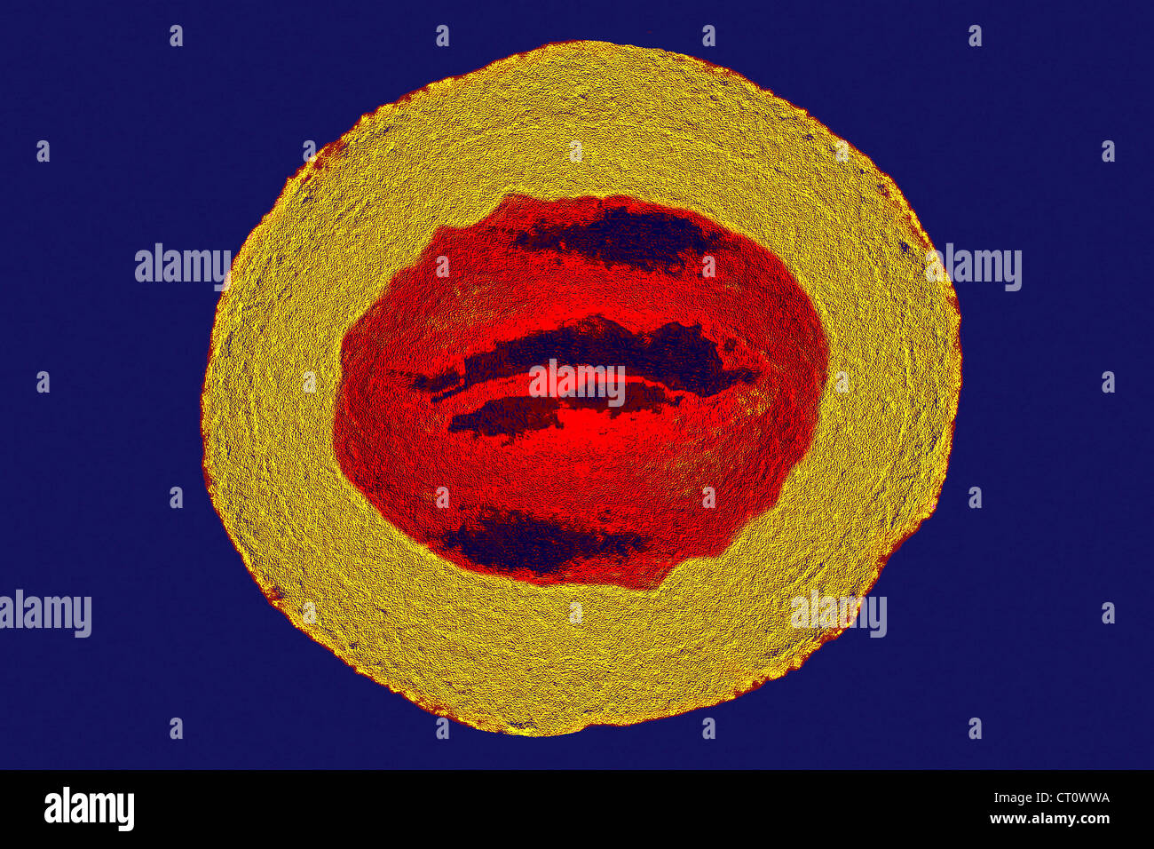 Atheroma High Resolution Stock Photography and Images - Alamy