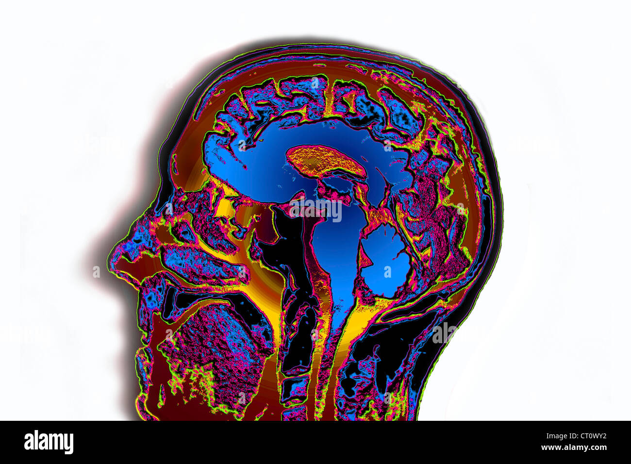 Normal brain mri scan hi-res stock photography and images - Alamy
