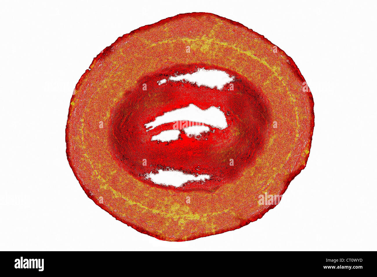 Cholesterol atheroma hi-res stock photography and images - Alamy