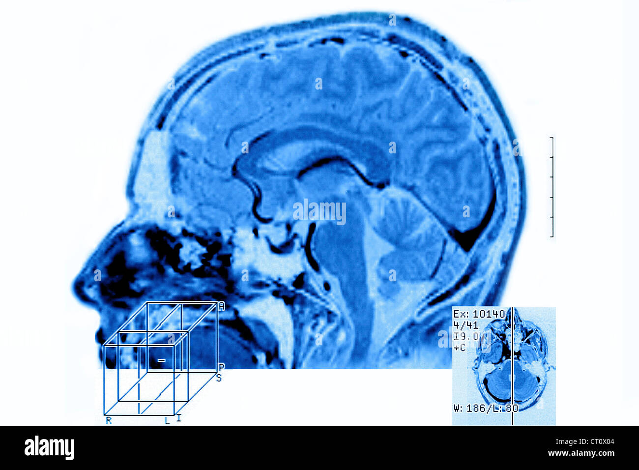 Normal brain mri scan hi-res stock photography and images - Alamy