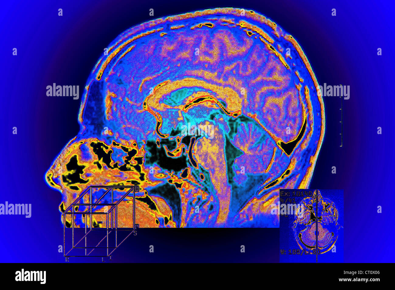 Normal brain mri scan hi-res stock photography and images - Alamy