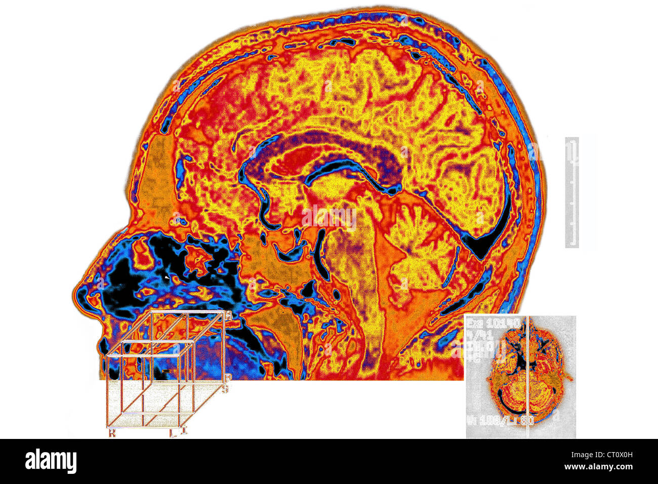 Normal Brain Mri Scan Stock Photos & Normal Brain Mri Scan Stock Images ...