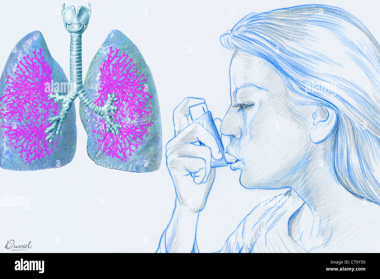 ASTHMA TREATMENT, ILLUSTRATION Stock Photo - Alamy