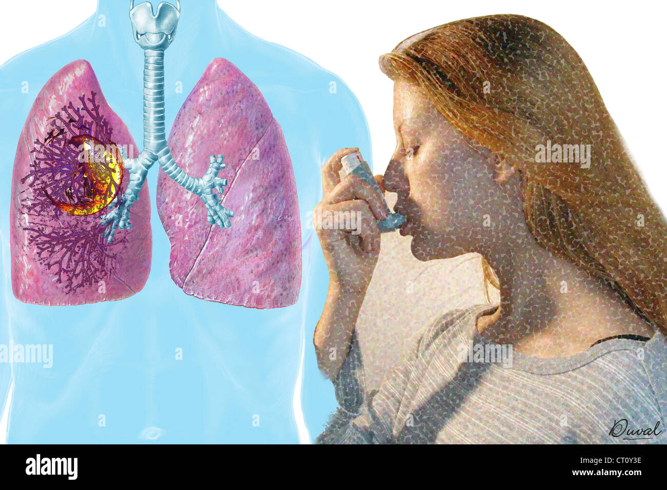 Asthma illustration hi-res stock photography and images - Alamy