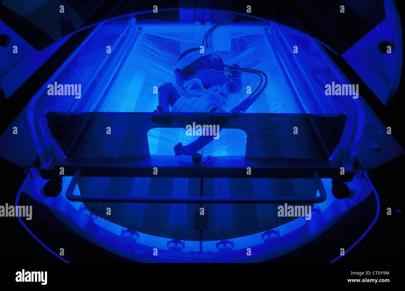 NEONATAL JAUNDICE, PHOTOTHERAPY Stock Photo - Alamy